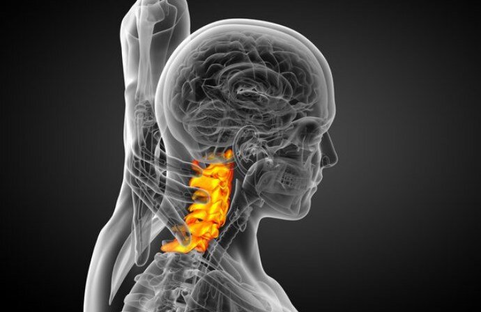 Servikal Spondiloz'un Belirtileri ve Tedavisi • Doktordan Haberler